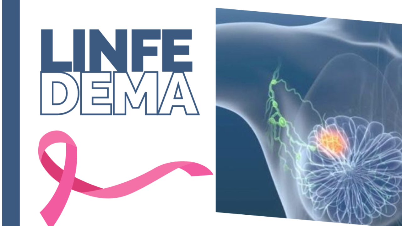 Cancro de mama, remoção de glânglios linfáticos e linfedema - andLINFA ...